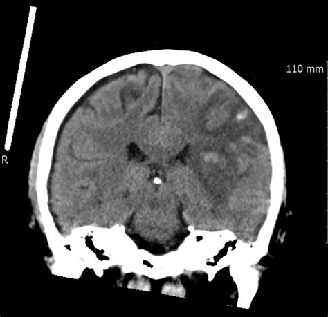 Pt Case Hemorrhagic Conversion In Cbr Infarction 둥이아빠 닥터 홍