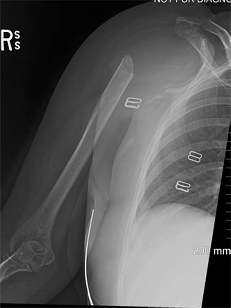 Internal Right Shoulder X Ray