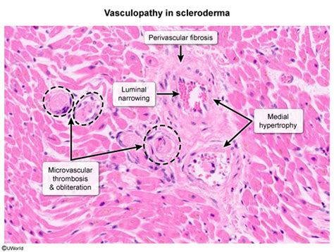 Scleroderma And Crest Syndrome Rheumatology And Orthopedics Uworld