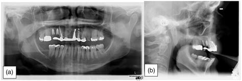 A Panoramic X Ray After Implant Surgery And B Lateral Cephalogram