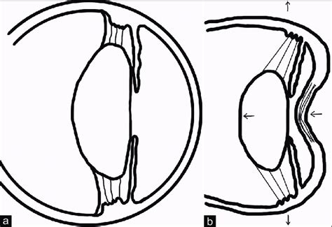 Sketch Of A Cross Section Of The Anterior Globe Centered Around The