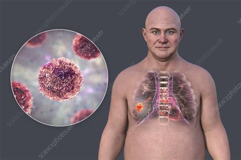 Lung Cancer Illustration Stock Image F0439670 Science Photo Library