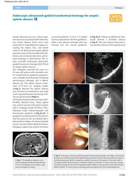 Pdf Endoscopic Ultrasound Guided Transluminal Drainage For Aseptic
