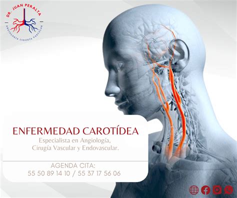Enfermedad CarotÍdea Las Arterias Carótidas Son Dos Grandes Vasos