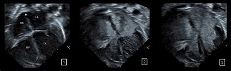Transthoracic Echocardiogram With Bubble Study Injection Of Agitated