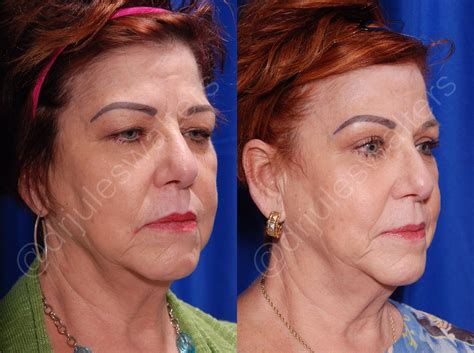 Blepharoplasty Before And After Photo Gallery Metairie New Orleans