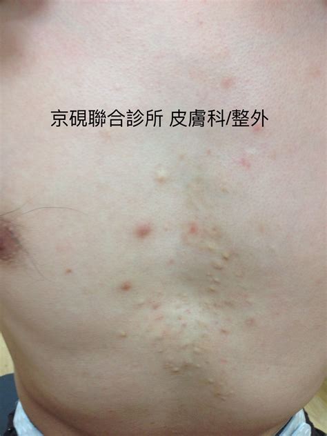 多發性皮脂囊腫 京硯皮膚科診所