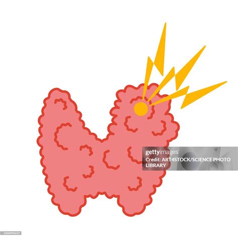 Enlarged Thyroid Gland Illustration High Res Vector Graphic Getty Images
