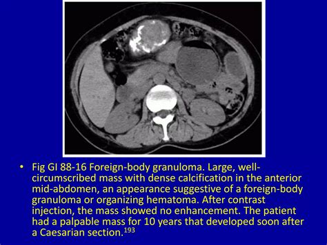 88 Peritoneal And Omental Abnormalities Pptx Digestive Disorders