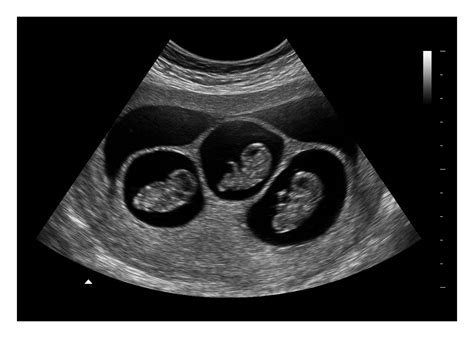 Buy 8 Weeks Triplets Ultrasound Realistic Triple Pregnancy Fake