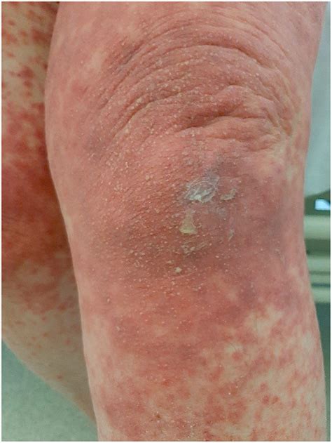 Clinical Appearance Of Acute Generalized Exanthematous Pustulosis On