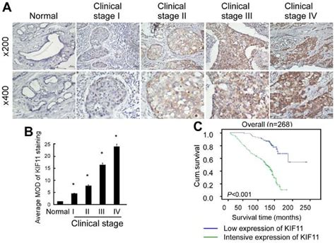 Overexpression Of KIF11 In Archived Breast Cancer Tissues A