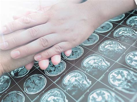 Pseudobulbar Affect And MS Causes Patient Information