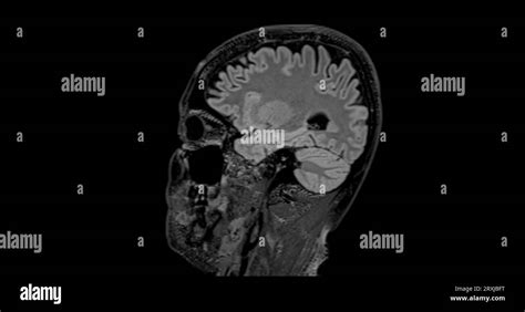 Mri Brain Scan Sagittal Flair For Detect Brain Diseases Sush As Stroke