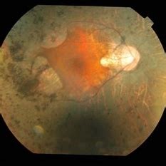 Gyrate Atrophy Of Choroid And Retina Retina Image Bank