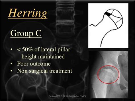 Classification Perthes Disease