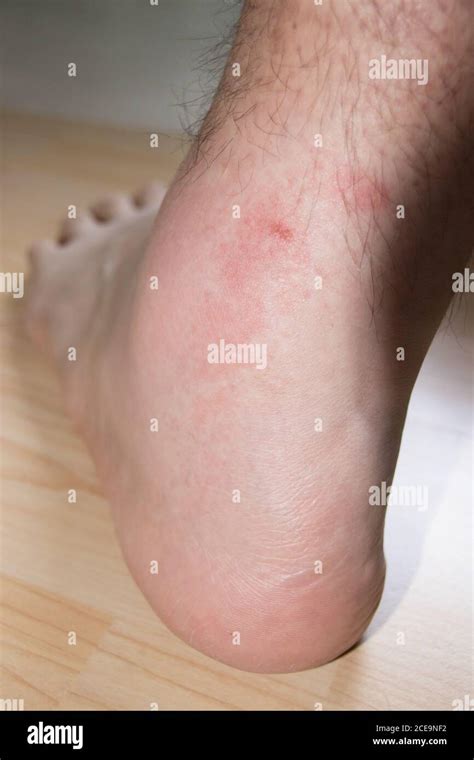 Tobillo Inflamado Humano Fotografías E Imágenes De Alta Resolución Alamy