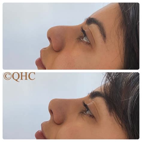 Non Surgical Rhinoplasty Bournemouth Quality Health Care