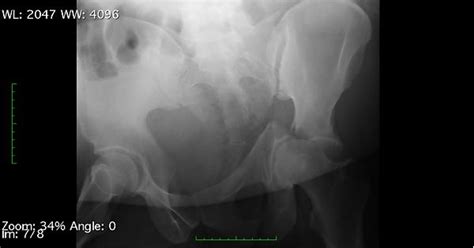 Fracture Acetabulum And Pelvis Album On Imgur