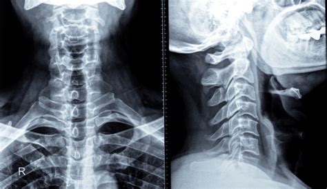 18 Calcification Cervical Royalty Free Photos And Stock Images
