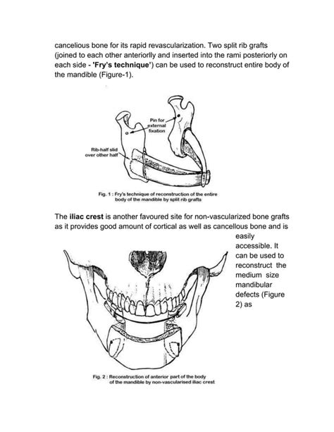 Mandibular Reconstruction Docx Death Injury Or Military Conflict