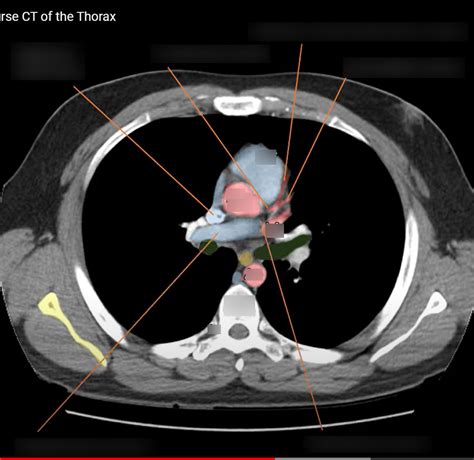 Ct Scan Left Coronary Vessels Diagram Quizlet