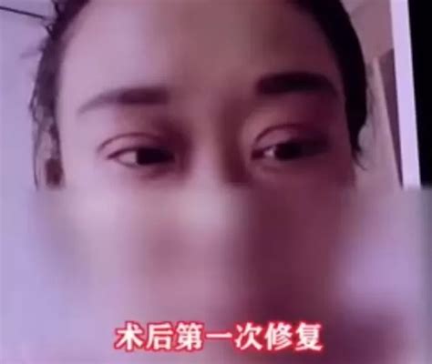 350만원 들여 쌍꺼풀 수술 했는데 더 못생겨졌다며 남편한테 이혼 통보 받았습니다 네이버 포스트