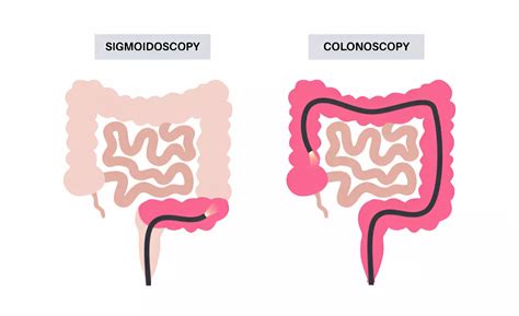 Sigmoidoscopy A Key Procedure For Colon Health