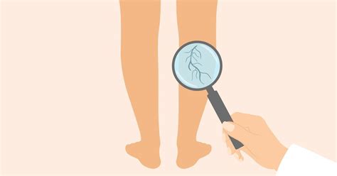 Can You Stop Varicose Veins From Forming Doctors Have Some Good News