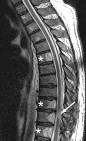 Vertebral Body Hemangioma Mri Radiology Wrocawski Informator