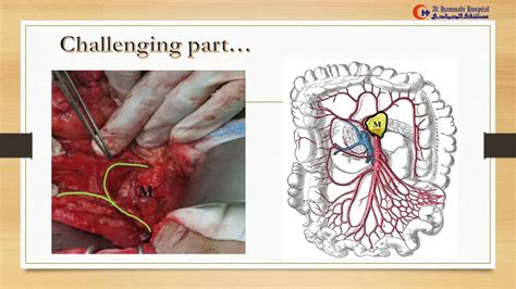 Compressive Mesenteric Cyst Challenging Surgery Pptx