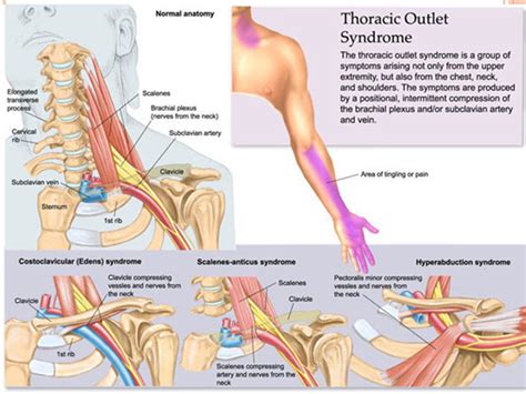 Cervical Rib Thoracic Outlet Syndrome Overview Diagnosis