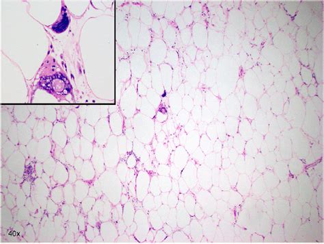 Histology At Low Power Magnification Shows Variable Sized Mature