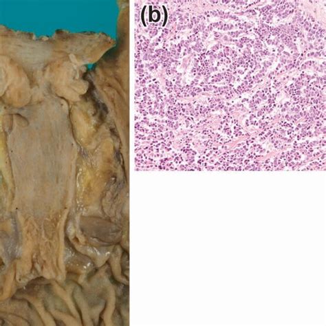 A Macroscopic Findings For The Resected Specimen Showed A Papillary