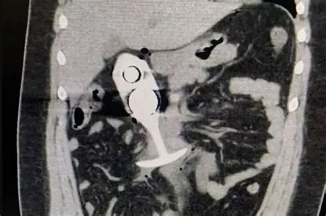 Woman Suffers Horrifying Injuries As Sex Toy Dragged Through Body In MRI Scan The Mirror