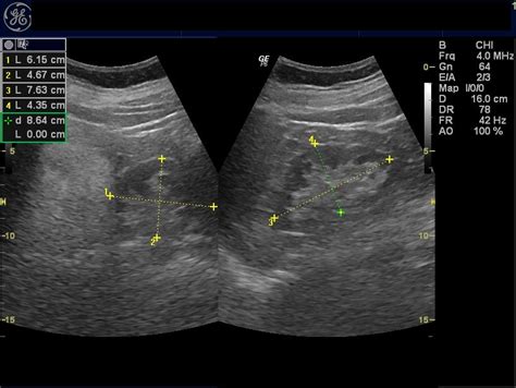 Cochinblogs Sonography Of Right Renal Mass