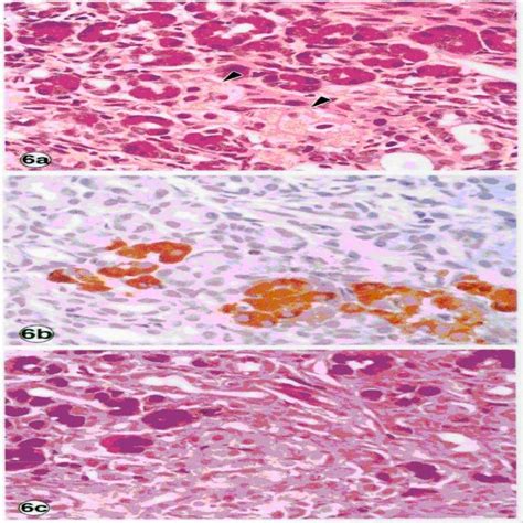 —ectopic Pancreatic Tissue Within The Stroma Of The Cystic Lesion A