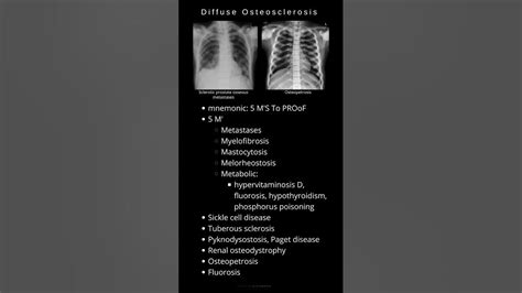 Causes For Diffuse Osteosclerosis Radiology Tutorials 1000 Cases In