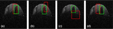 Figure 1 From Lesion Detection In Optical Coherence Tomography With
