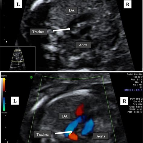 A Fetal ECHO Axial View Showing The Left Pulmonary Artery LPA Download Scientific Diagram
