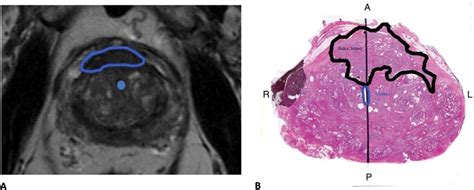 Ju Insight Magnetic Resonance Imaging For Localizing Prostate Cancer