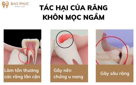 Răng Khôn Mọc Ngầm Không đau Có Nên Nhổ Không Địa Chỉ Nhổ Răng Khôn Uy