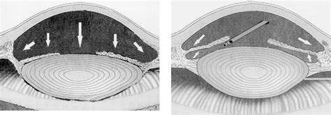 Eye Iris Diaphragm