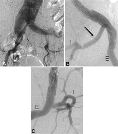 Internal Iliac Artery Revascularization As An Adjunct To Endovascular