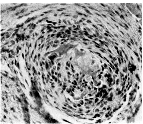 Osteoclastic Resorption Of Bone Trabeculae Induced By Ish Cells