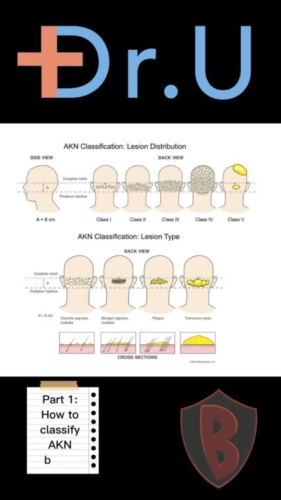 Dr U Hair And Skin Clinic On Linkedin Akn Acnekeloidalisnuchae