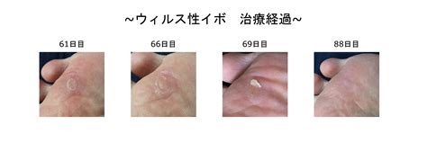 疣 JapaneseClass jp
