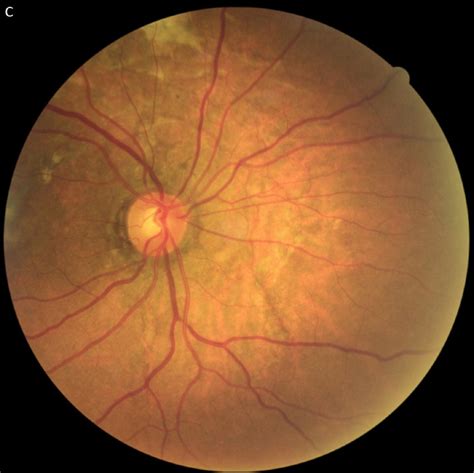 Optical Coherence Tomography Angiography For Choroidal
