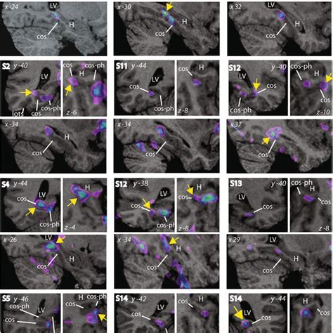 Activation Peaks Along The Posterior Parahippocampal Cortex