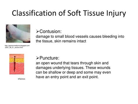 Ppt Soft Tissue Injury Powerpoint Presentation Id1634436